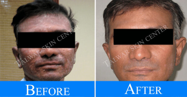 Best Dermatology Treatment in Lucknow | Talwar Skin Centre